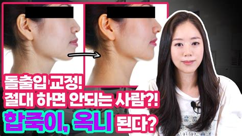 돌출입 교정 절대 하면 안되는 사람도 있다 치아교정 부작용 같이 알아봐요 Youtube