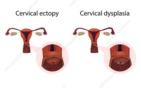 Cervical Ectopy And Cervical Dysplasia Illustration Stock Image F027 9752 Science Photo