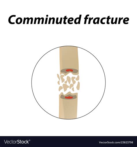 Comminuted Fracture Tatatown