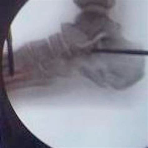 Showing The Tongue Type Calcaneal Fracture In The Same Patient Download Scientific Diagram