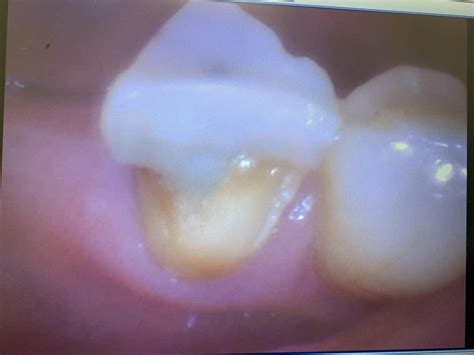 Tooth With Post Fractured Likely Exposing Canal Next Steps Rdentistry