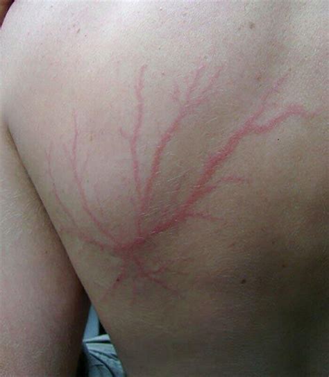 Lichtenberg Figures The Rare Scars Of Those Who Survived A Lightning
