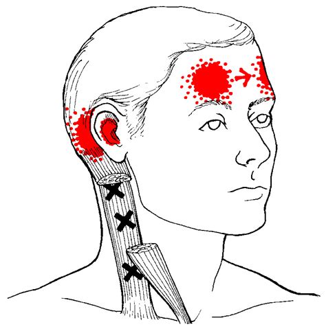 Muscle Trigger Points Self Massage
