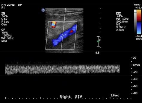 Spectral Doppler Waveform Analysis Of The External Iliac Vein Eiv