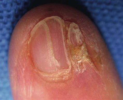 Lichen Planus Nails Lichen Planus Signs And Symptoms