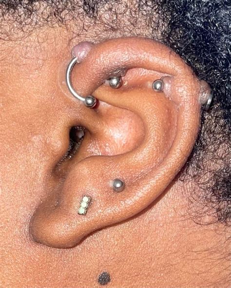 Hypertrophic Scar Vs Keloid Piercing