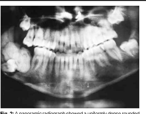 Figure 1 From Complex Odontoma Intraosseous Type Associated With