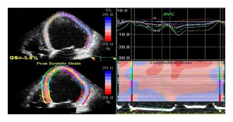 Examples Of Strain Imaging Using Speckle Tracking Echocardiography On Download Scientific