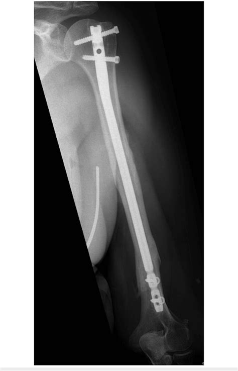 Anterior Posterior Humerus Radiograph Demonstrating A Healed Segmental Download Scientific