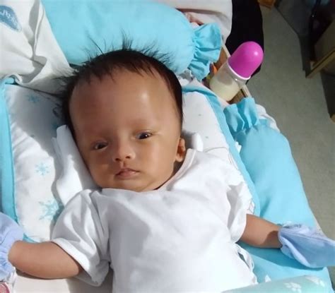 Dandy Walker Syndrome