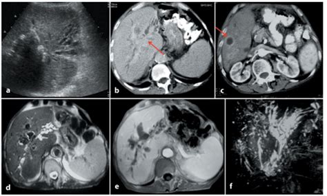 Cholangitis Ultrasound