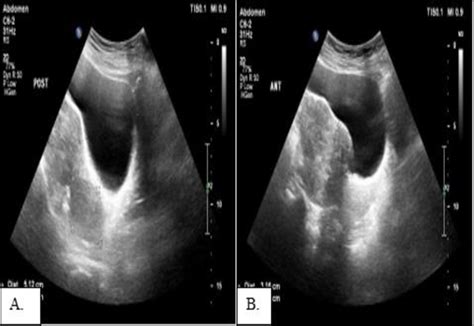 Usg Image Showing Multiple Uterine Fibroids Download Scientific Diagram