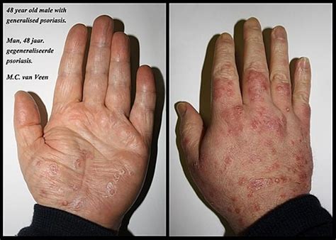 Psoriasis Of Hands And Feet Including Palmoplantar Pustulosis Doctor