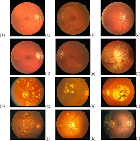 Figure 1 From Fully Automated Method For Glaucoma Screening Using Robust Optic Nerve Head