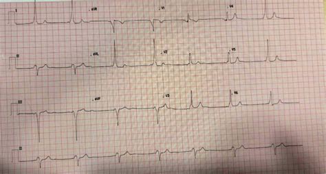 Figure The Initial Electrocardiogram Which Was Taken In Emergency Download Scientific Diagram