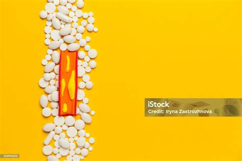 Pengobatan Aterosklerosis Vaskular Plak Kolesterol Di Pembuluh Darah Ruang Salin Foto Stok