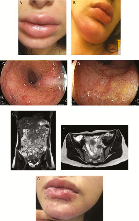 Ustekinumab Successfully Treats And Maintains Remission Of Pyostomatitis Vegetans Associated