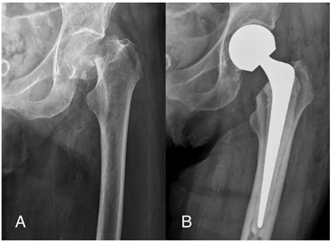 Management Of An Intracapsular Hip Fracture Note The Patient In This