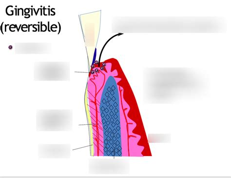Gingivitis Diagram Quizlet
