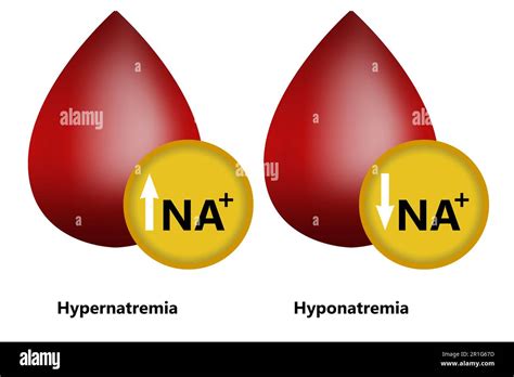 Uptodate Hyponatremia