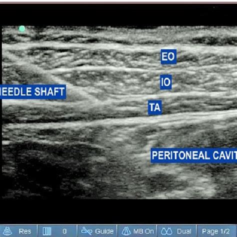 Sonographic Image Showing Insertion Of Sonotap Needle With The Needle Download Scientific