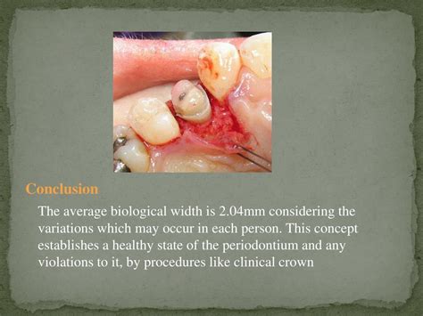 Ppt Biologic Width Powerpoint Presentation Free Download Id7372199