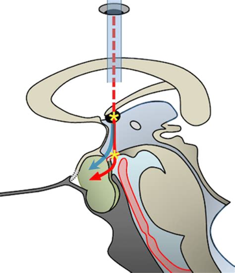 Planned Route To The Intrasellar Arachnoid Cyst Trans Tuberal Download Scientific Diagram