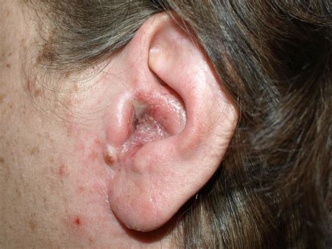 Otitis Externa Concise Medical Knowledge