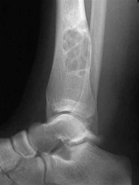 Nonossifying Fibroma Wheeless Textbook Of Orthopaedics