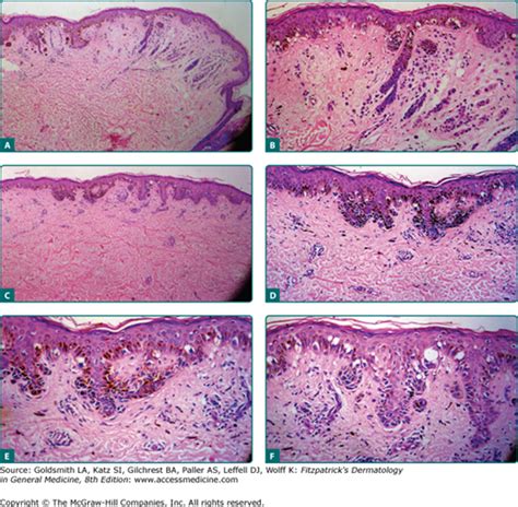 Dysplastic Nevus Histology