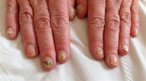 What Causes Fingernail Fungus Symptoms And Treatment Nd Nails Supply