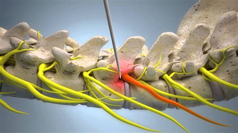 Spinal Nerve Block En Version Youtube