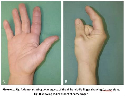 Infectious Flexor Tenosynovitis Flexor Tenosynovitis Is An Infection
