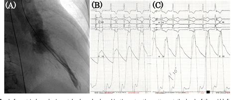 Figure 3 From Mid Ventricular Obstruction Occurred In Hypertrophic Left