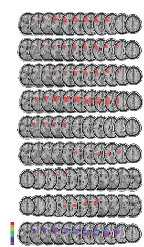 Magnetic Resonance Imaging Mri Reconstructions Of The Lesioned Brain Download Scientific