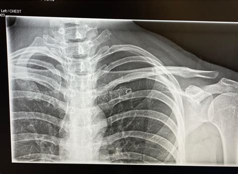 Rib Joint Radiology At Oliver Vaccari Blog