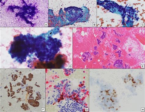 Lymph Node Fna Cytology Findings A Some Groups Of Cells Were Organized