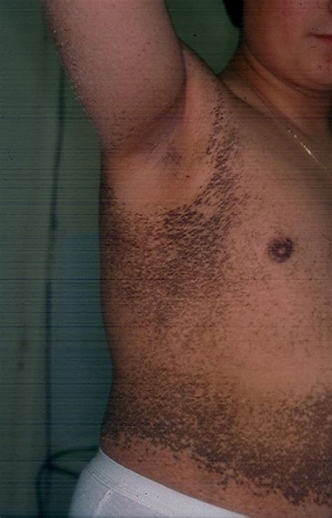 Genodermatoses X Linked Ichthyosis Picture Hellenic Dermatological Atlas Over 2700