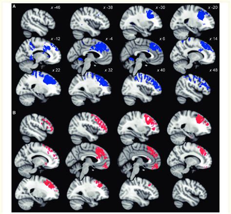 Functional Connectivity Of The Pre Sma Associated With Abnormal Action