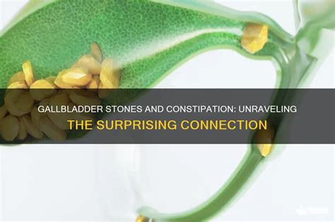 Gallbladder Stones And Constipation Unraveling The Surprising Connection Medshun