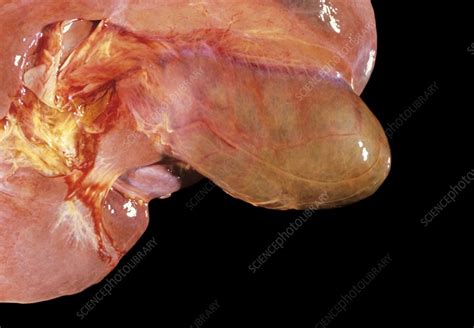 Inflamed Gallbladder Stock Image C022 7256 Science Photo Library