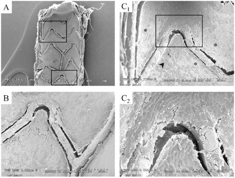 Figure 1 From Time Course Of Stent Endothelialization After
