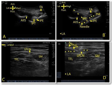 Does Adding Lateral Femoral Cutaneous Nerve Block Improves The Analgesia Of Pericapsular Nerve