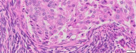 Human Endometrial Cancer Ffpe Sections