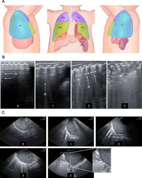 Description Of The Modified Lung Ultrasound Score Each Lung Has Been Download Scientific