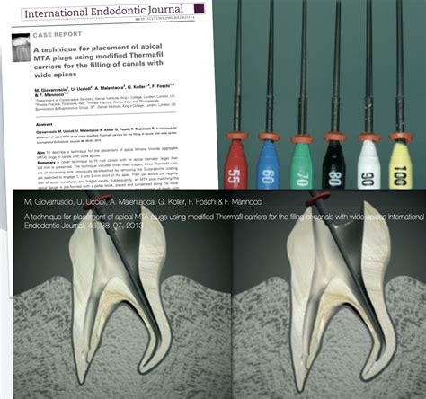 Management Of Deep Root Perforations Style Italiano Endodontics