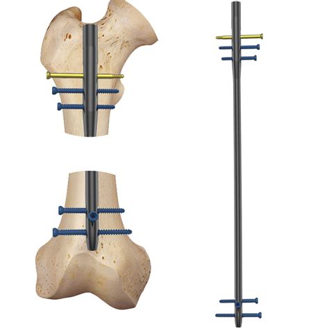 Femoral Intramedullary Nail Navy S Ar Dunitech Titanium