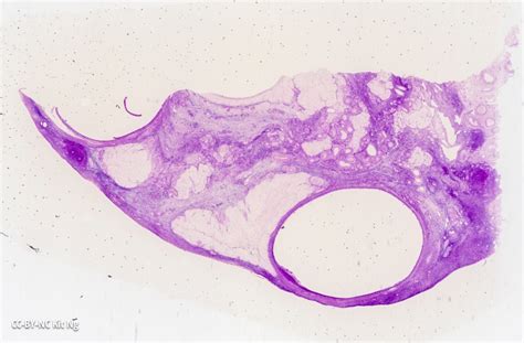 Corpus Albicans Kit Ng Phd