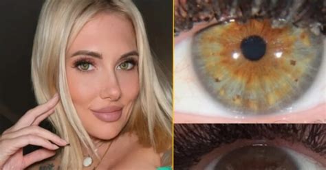 초록색 눈이 갈색으로 번개 맞고 눈동자 색이 변한 女 어떻게 가능