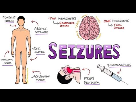 Different Types Of Seizures Chart Top Picked From Our Experts
